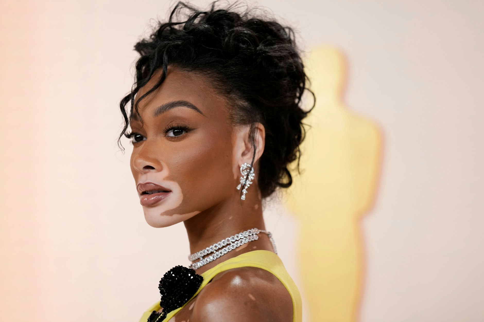 Vitiligo: Lifestyle-Problem oder ernste Erkrankung?