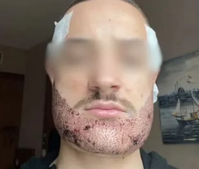 Makler verpfuscht Haartransplantation in Türkei – Opfer übel entstellt